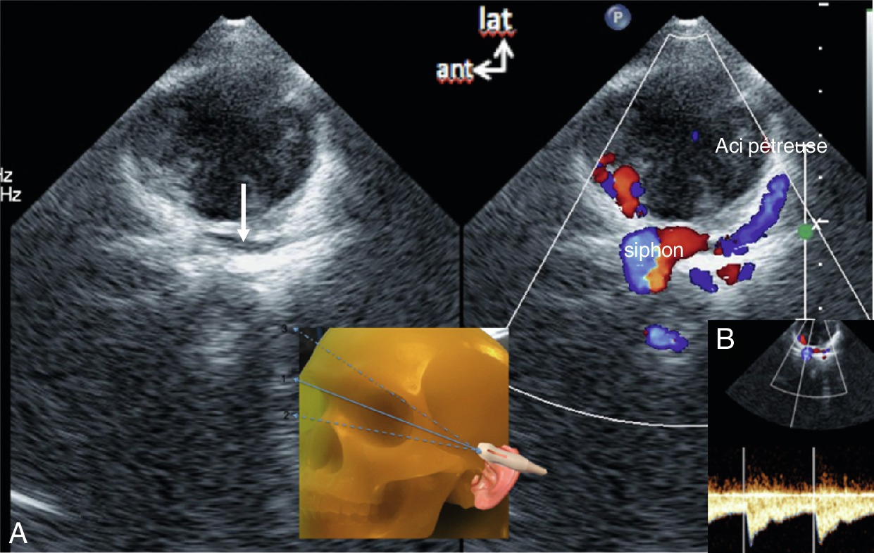 Guide pratique d'écho-Doppler vasculaire