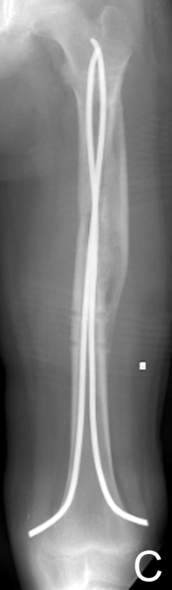 Orthopédie et traumatologie de l'enfant