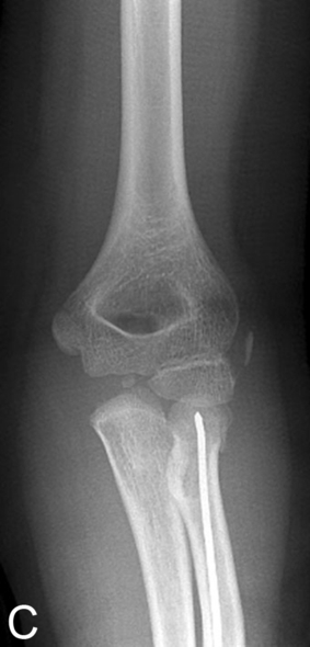 Orthopédie et traumatologie de l'enfant