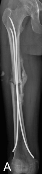 Orthopédie et traumatologie de l'enfant