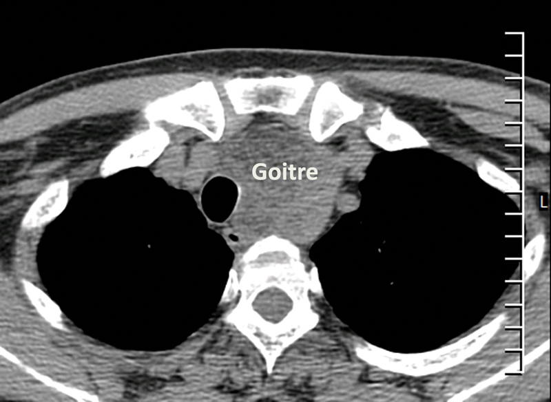 Échographie thyroïdienne et parathyroïdienne