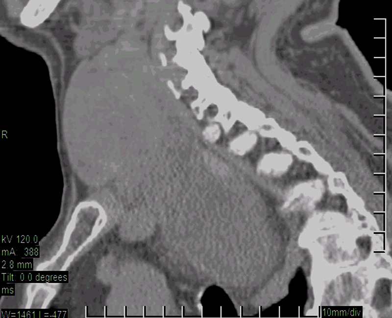Échographie thyroïdienne et parathyroïdienne