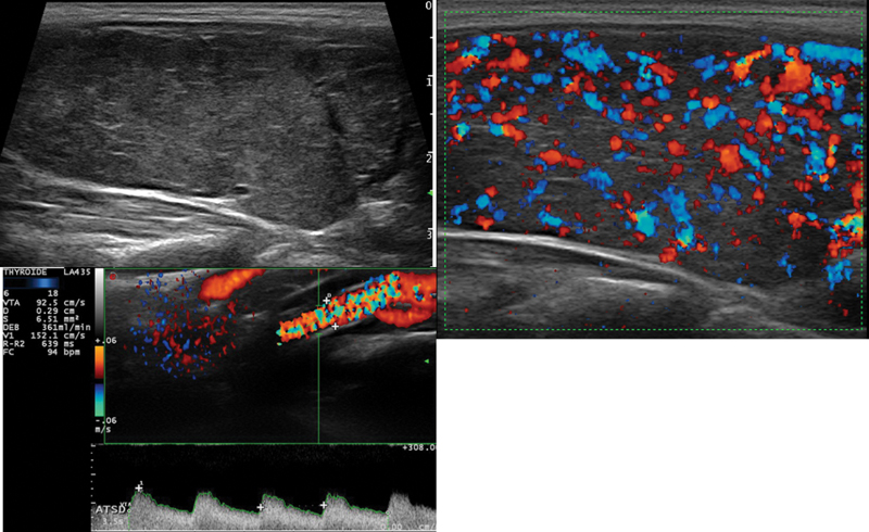 Échographie thyroïdienne et parathyroïdienne