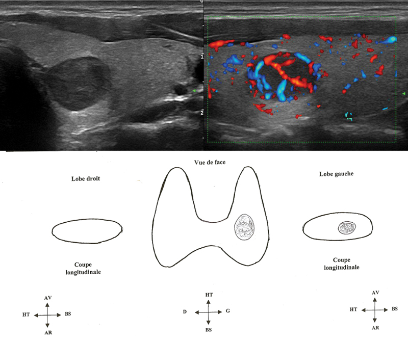 Échographie thyroïdienne et parathyroïdienne