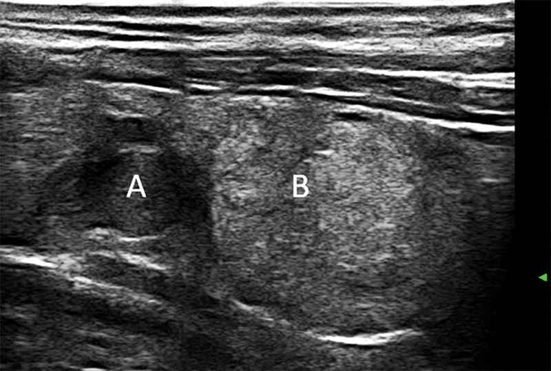 Échographie thyroïdienne et parathyroïdienne