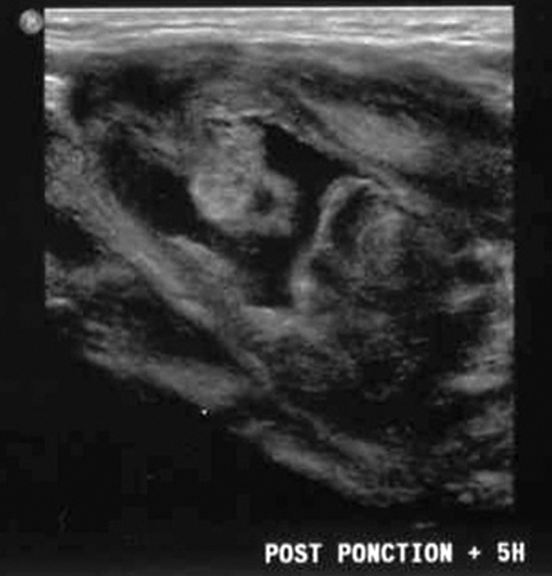 Échographie thyroïdienne et parathyroïdienne