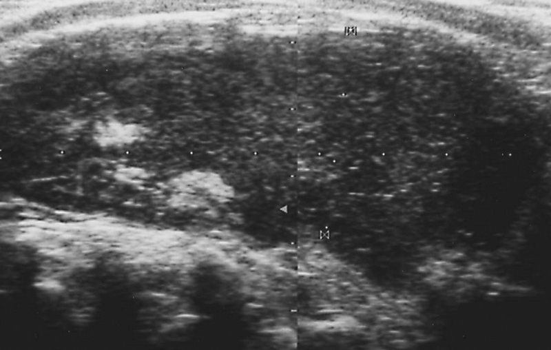 Échographie thyroïdienne et parathyroïdienne