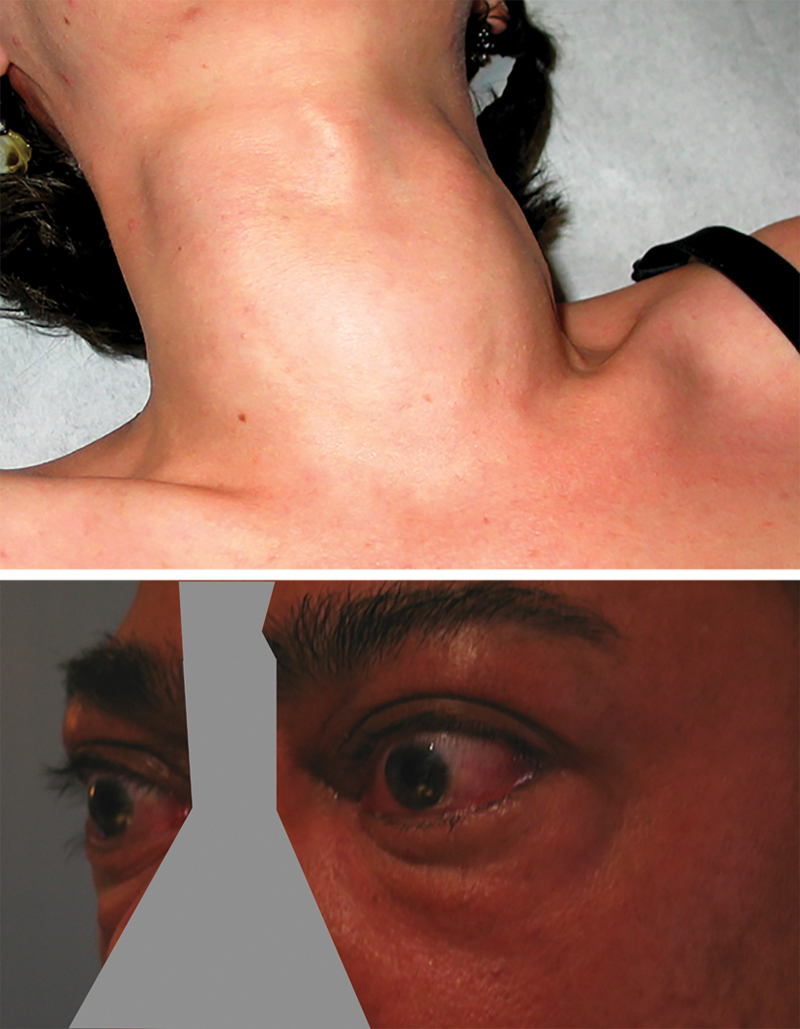 Échographie thyroïdienne et parathyroïdienne