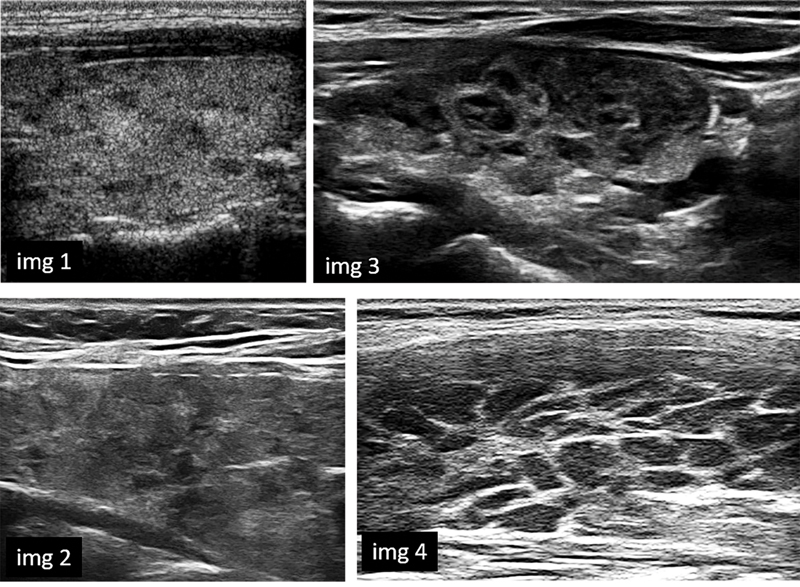 Échographie thyroïdienne et parathyroïdienne