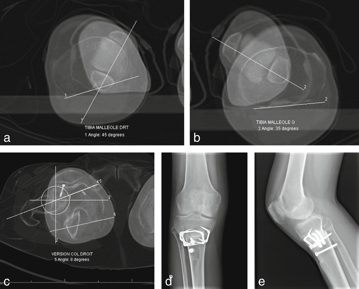Les ostéotomies autour du genou