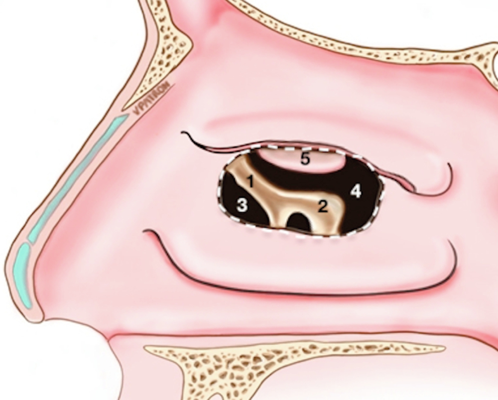 Chirurgie endoscopique endonasale