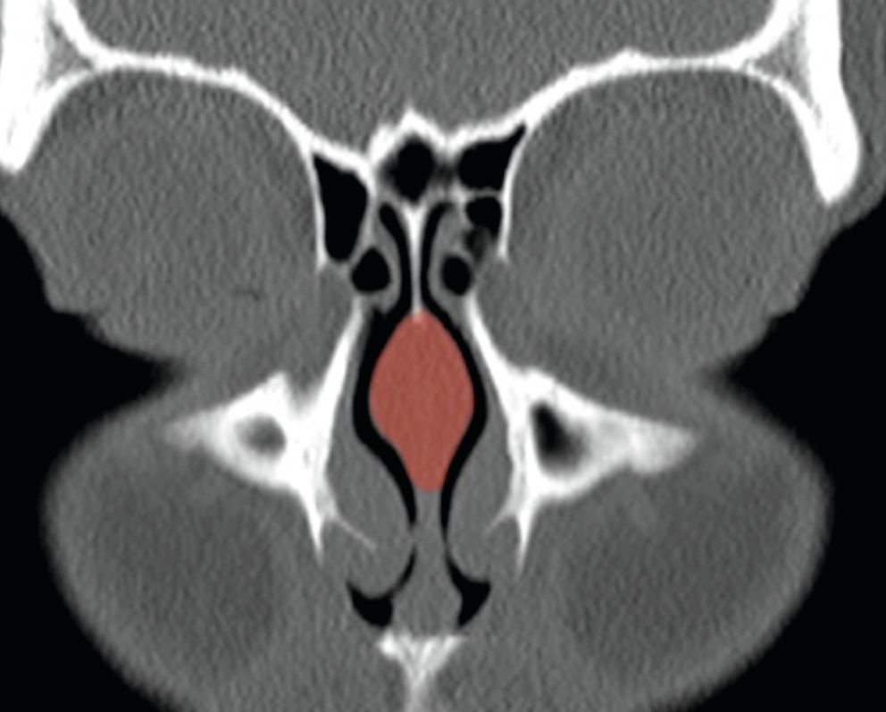 Chirurgie endoscopique endonasale