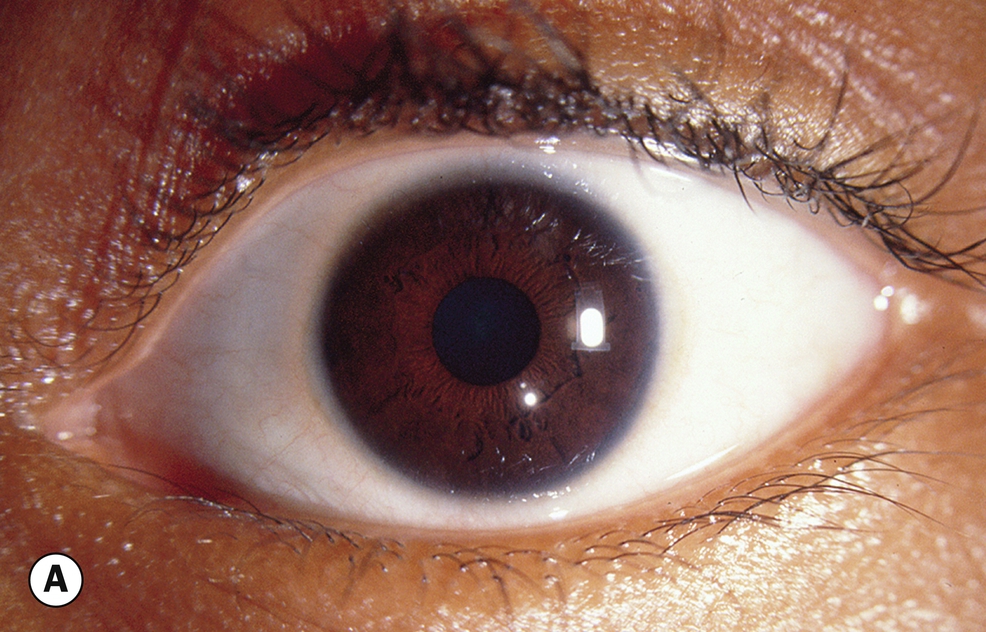 KANSKI Ophtalmologie clinique