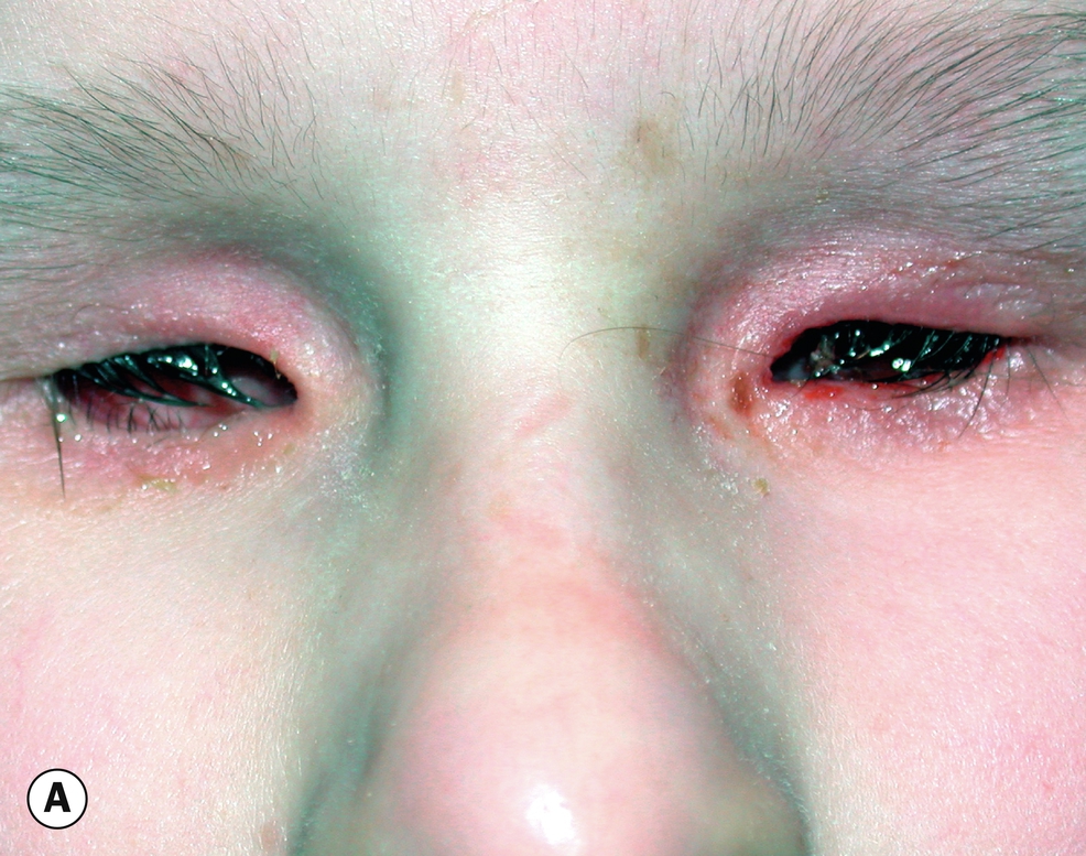 KANSKI Ophtalmologie clinique