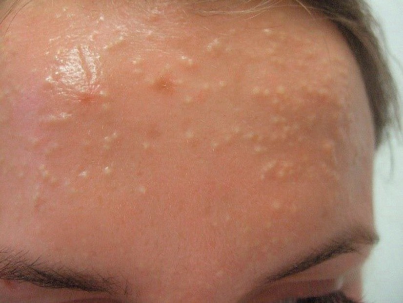 Chapitre 1: Item 111 – Dermatoses faciales: acné, rosacée, dermatite ...