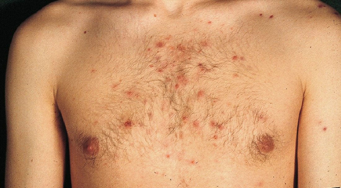 Chapitre 1: Item 111 – Dermatoses faciales: acné, rosacée, dermatite ...