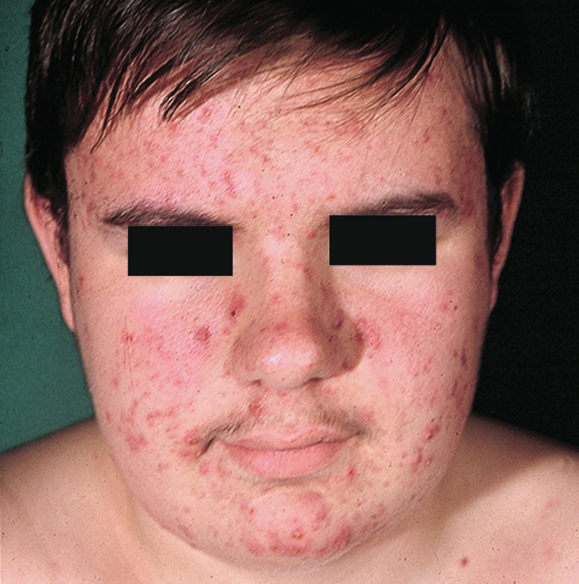 Chapitre 1: Item 111 – Dermatoses faciales: acné, rosacée, dermatite ...