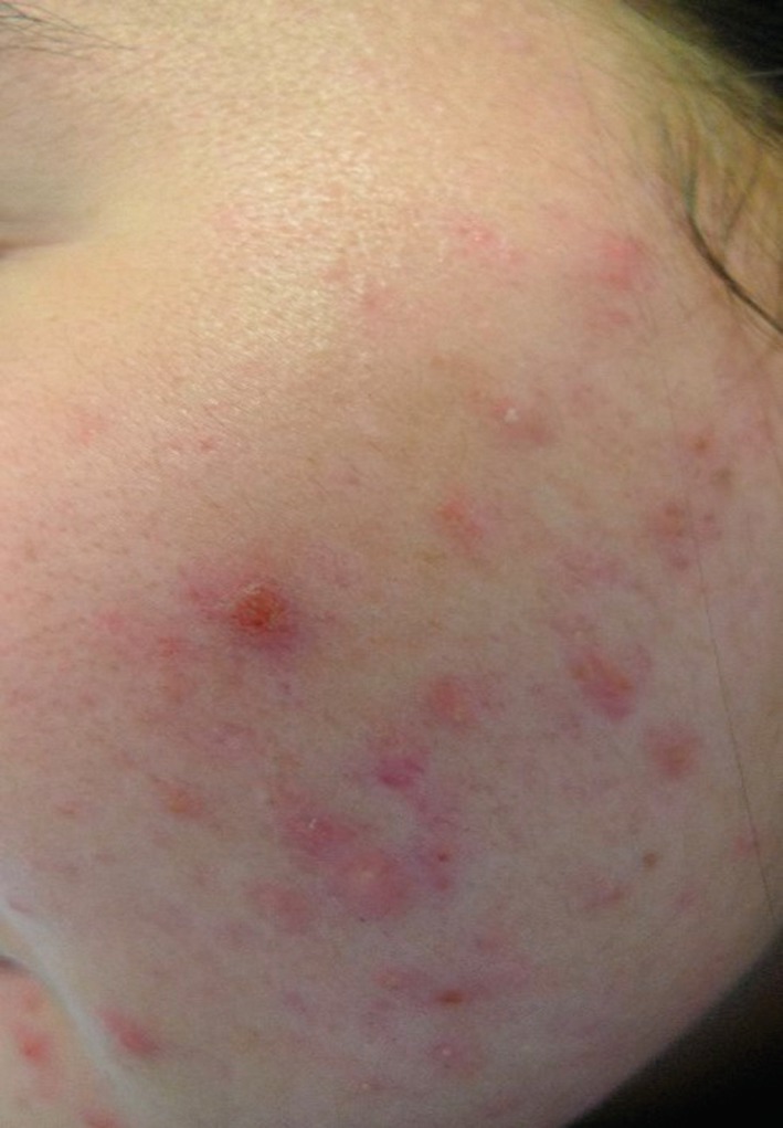 Chapitre 1: Item 111 – Dermatoses faciales: acné, rosacée, dermatite ...