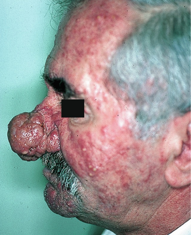 Chapitre 1: Item 111 – Dermatoses faciales: acné, rosacée, dermatite ...