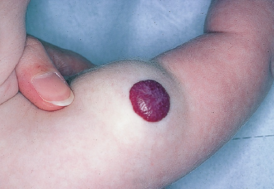 Chapitre 3: Item 113 – Hémangiomes et malformations vasculaires cutanées