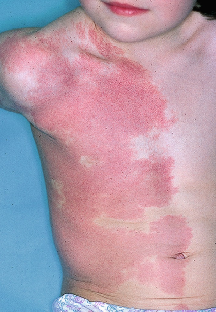 Chapitre 3: Item 113 – Hémangiomes et malformations vasculaires cutanées