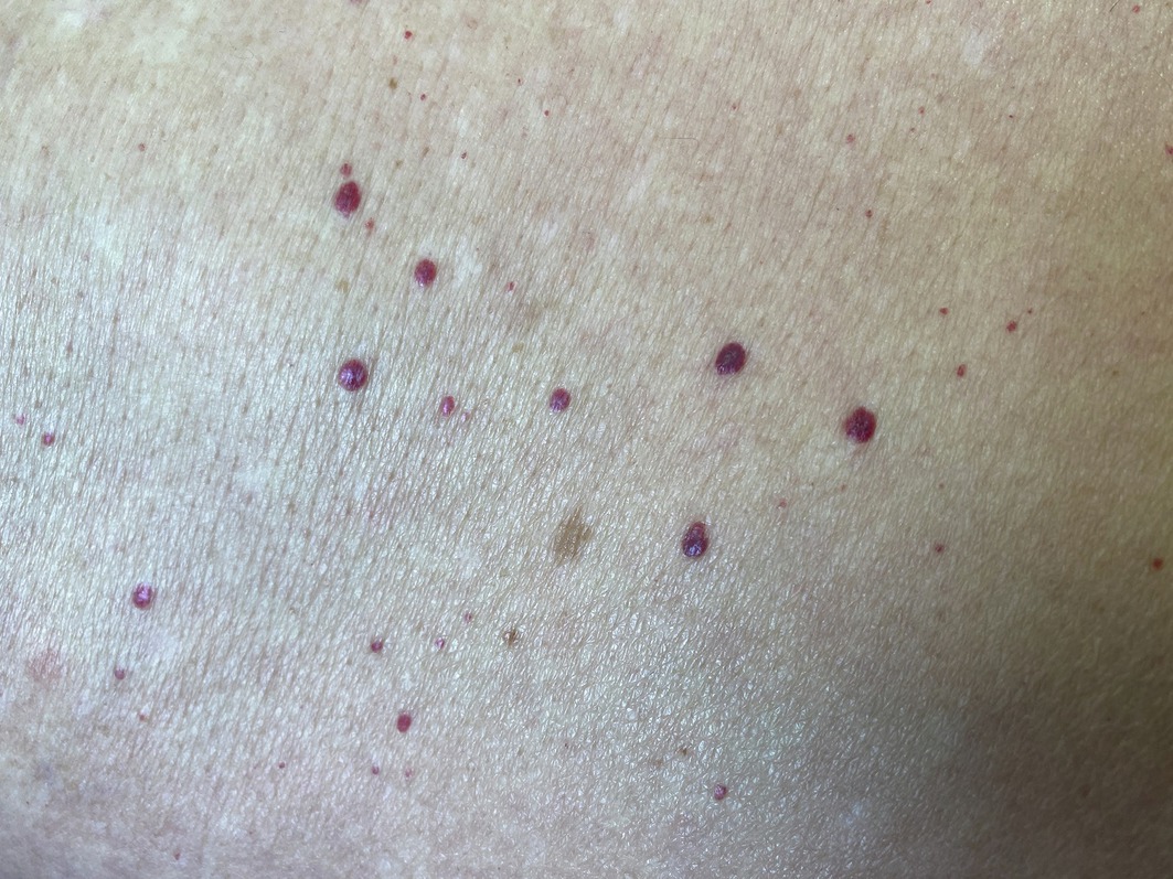 Chapitre 3: Item 113 – Hémangiomes et malformations vasculaires cutanées