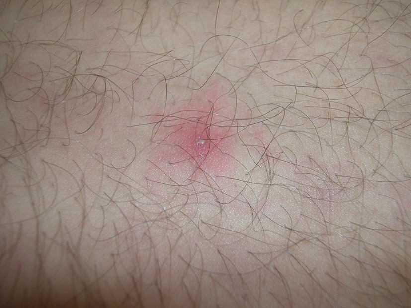 Chapitre 8: Item 155 – Infections cutanéo-muqueuses bactériennes et ...