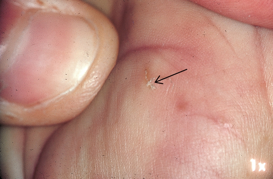 Chapitre 12: Item 171 – Ectoparasitoses cutanées: gale et pédiculose