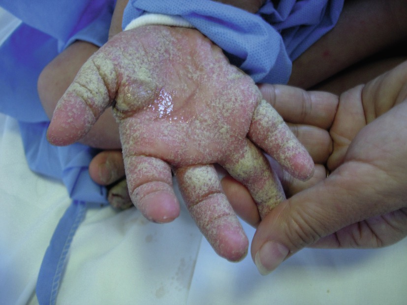 Chapitre 12: Item 171 – Ectoparasitoses cutanées: gale et pédiculose