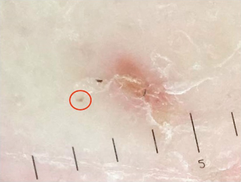 Chapitre 12: Item 171 – Ectoparasitoses cutanées: gale et pédiculose