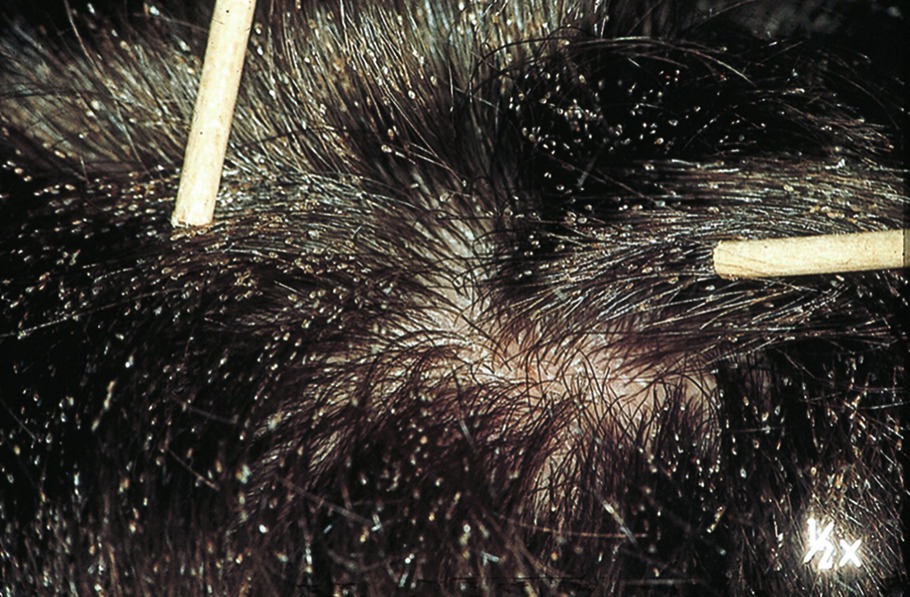 Chapitre 12: Item 171 – Ectoparasitoses cutanées: gale et pédiculose