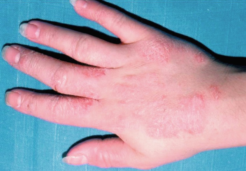 Chapitre 13: Item 187 – Hypersensibilités et allergies cutanéo ...