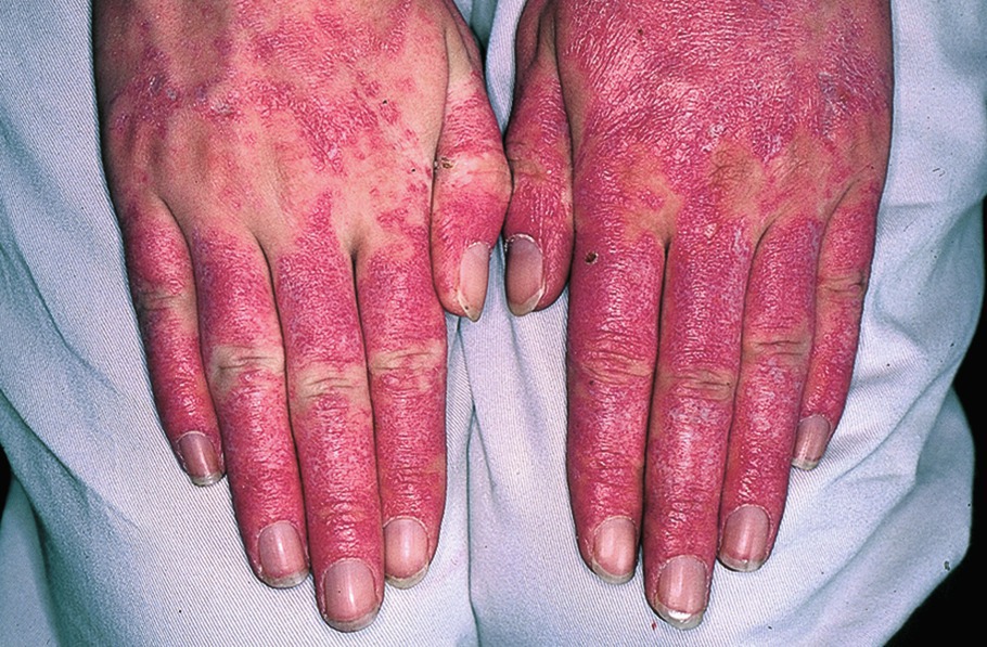 Chapitre 14: Item 194 – Lupus érythémateux disséminé