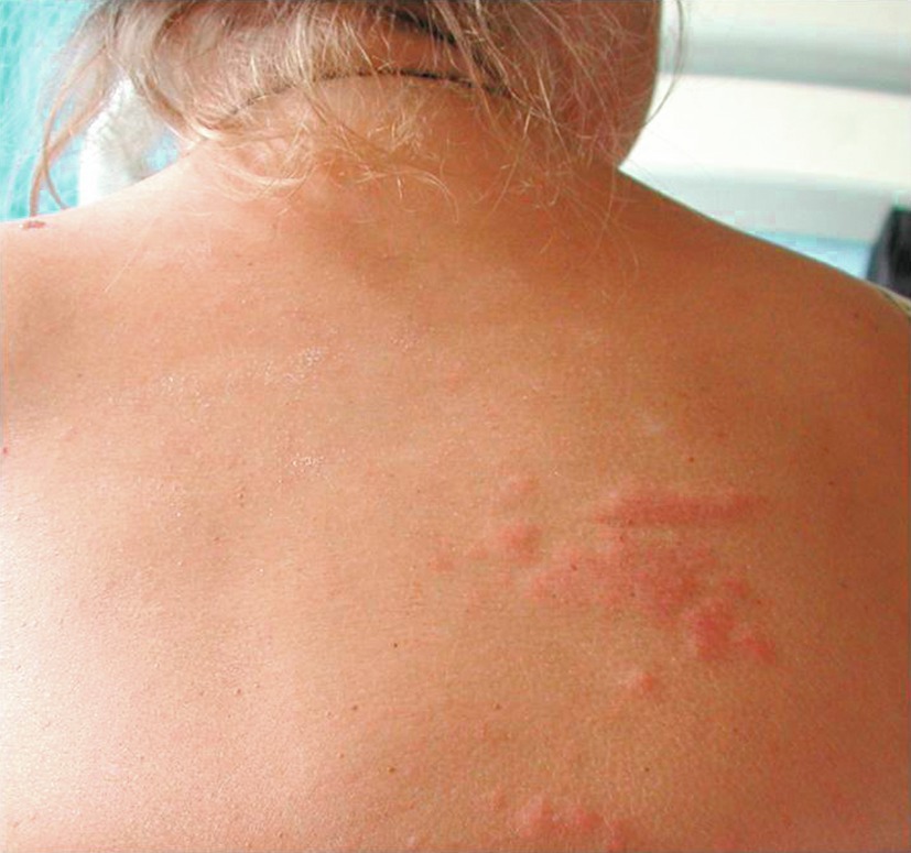 Chapitre 14: Item 194 – Lupus érythémateux disséminé