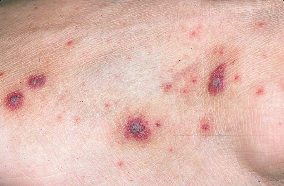 Chapitre 17: Item 215 – Purpura chez l'adulte et l'enfant