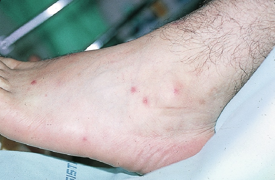 Chapitre 17: Item 215 – Purpura chez l'adulte et l'enfant