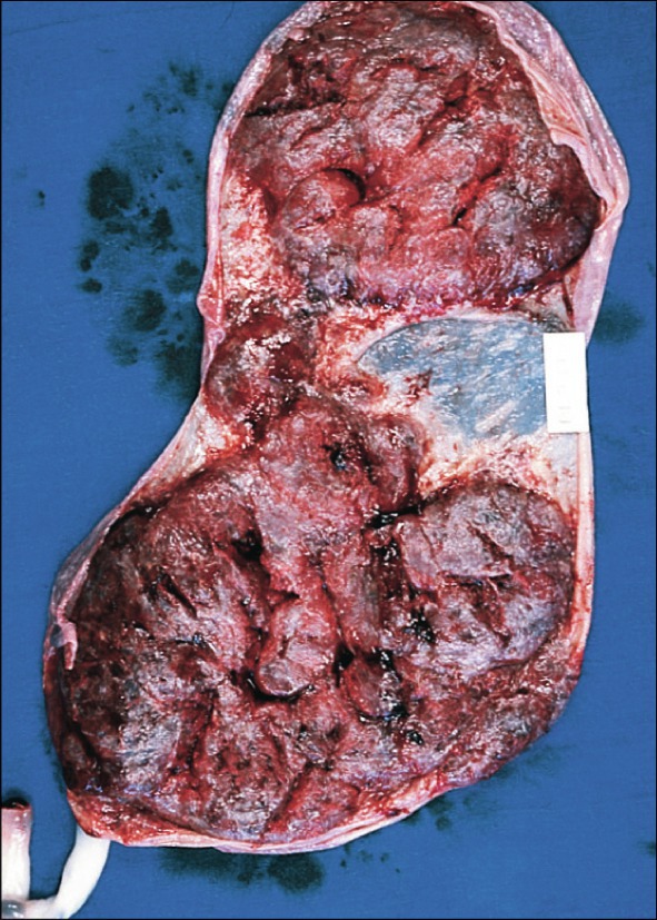 Chapitre 6: Délivrance et examen du placenta