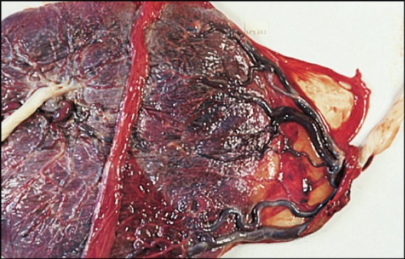 Chapitre 6: Délivrance et examen du placenta