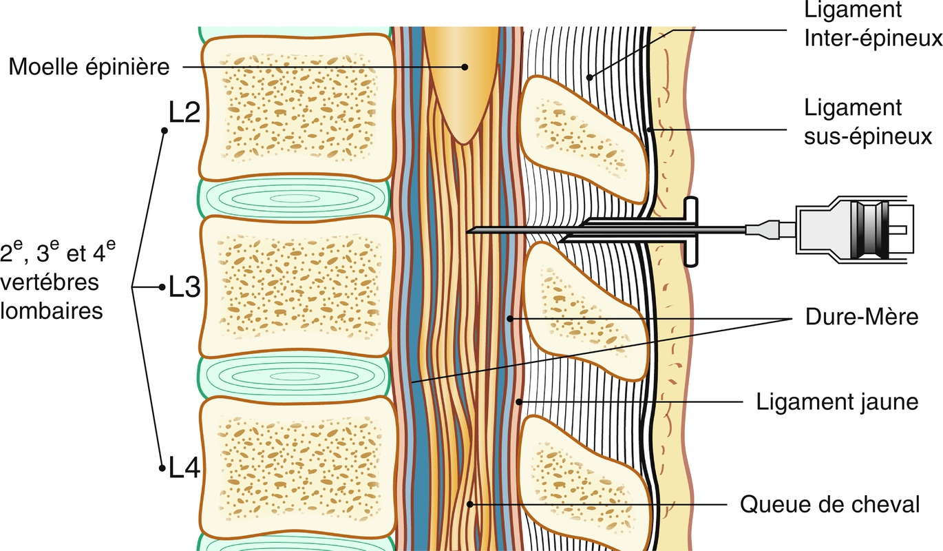 Chapitre 12: Douleur et analgésie obstétricale