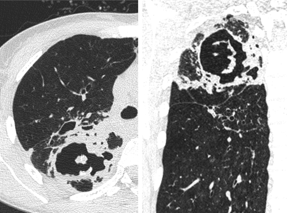 Chapitre 28: Aspergilloses et autres champignons filamenteux opportunistes