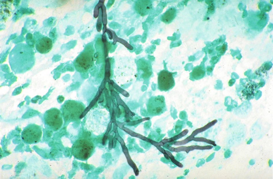 Chapitre 28: Aspergilloses et autres champignons filamenteux opportunistes