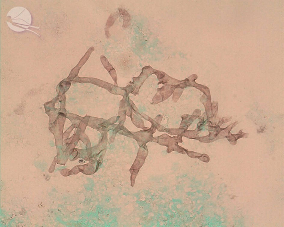 Chapitre 28: Aspergilloses et autres champignons filamenteux opportunistes