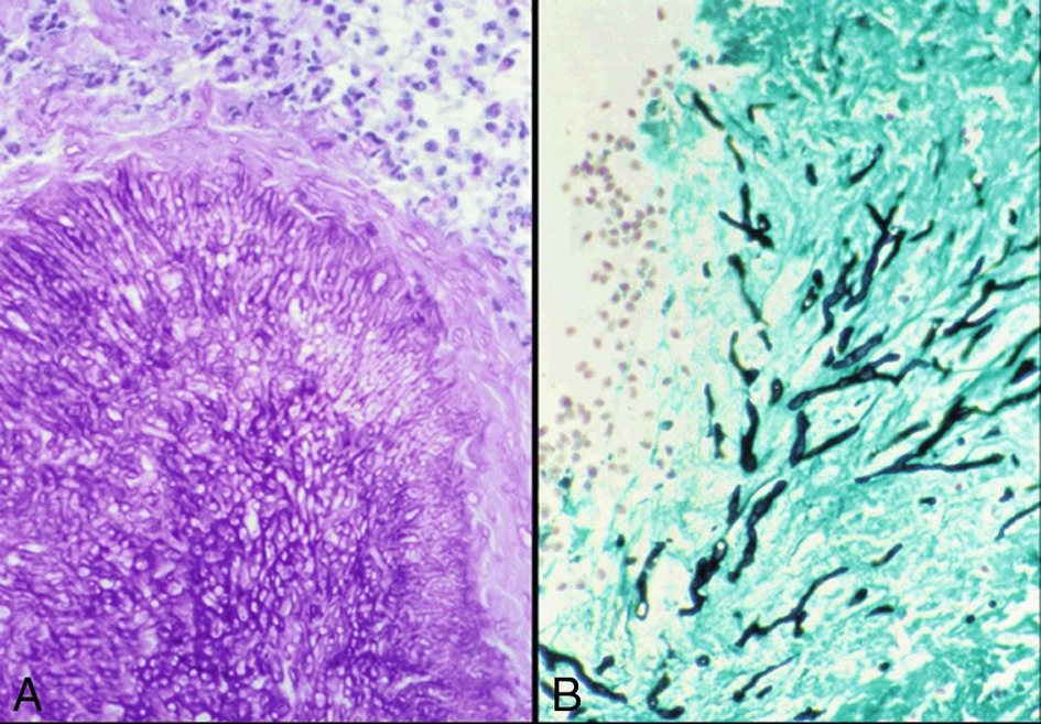 Chapitre 28: Aspergilloses et autres champignons filamenteux opportunistes
