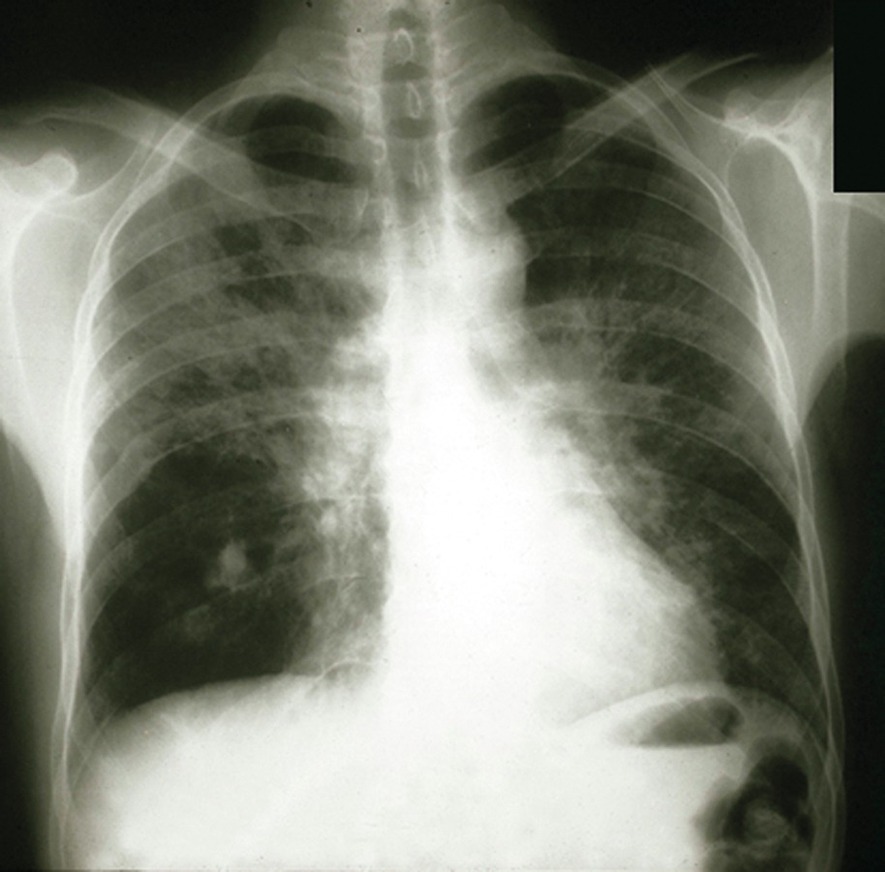 Chapitre 32: Pneumocystose