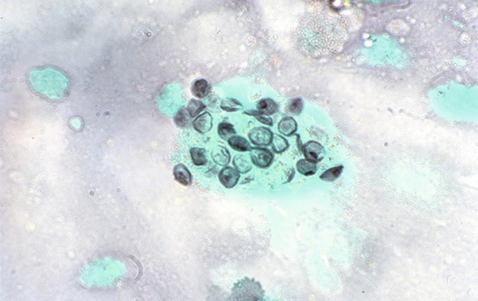 Chapitre 32: Pneumocystose