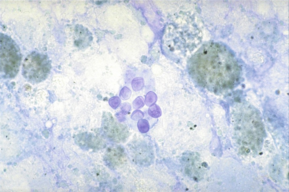 Chapitre 32: Pneumocystose