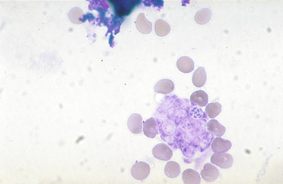 Chapitre 32: Pneumocystose