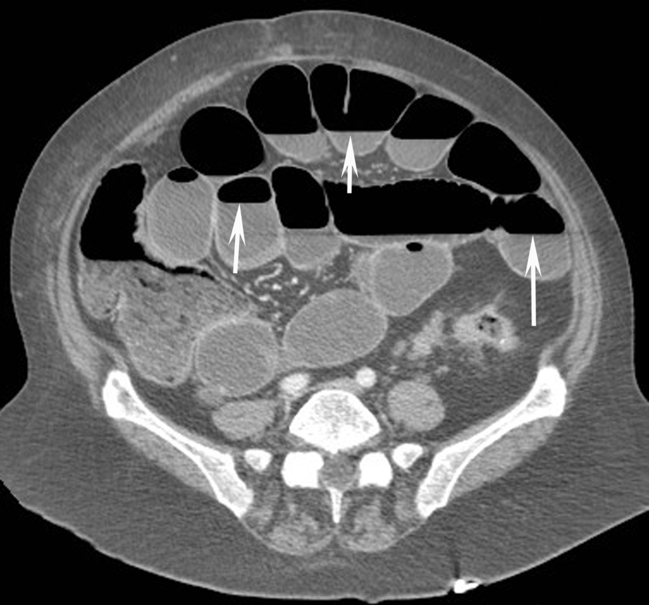 Chapitre 14: Syndrome occlusif del'enfant et de l'adulte