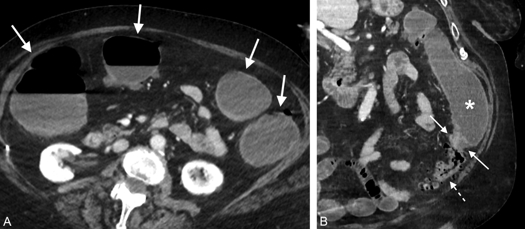 Chapitre 14: Syndrome occlusif del'enfant et de l'adulte