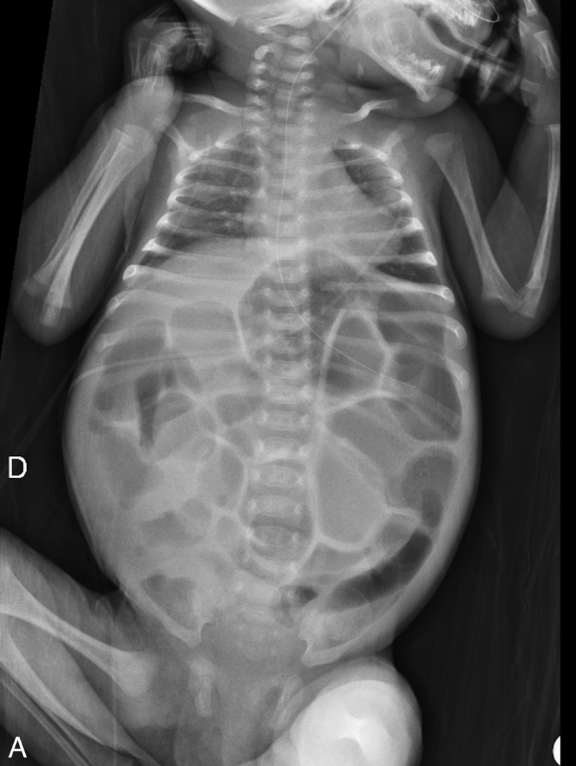 Chapitre 14: Syndrome occlusif del'enfant et de l'adulte